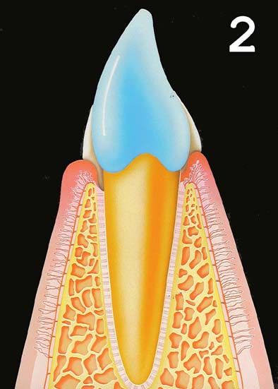 Karies & Parodontitis